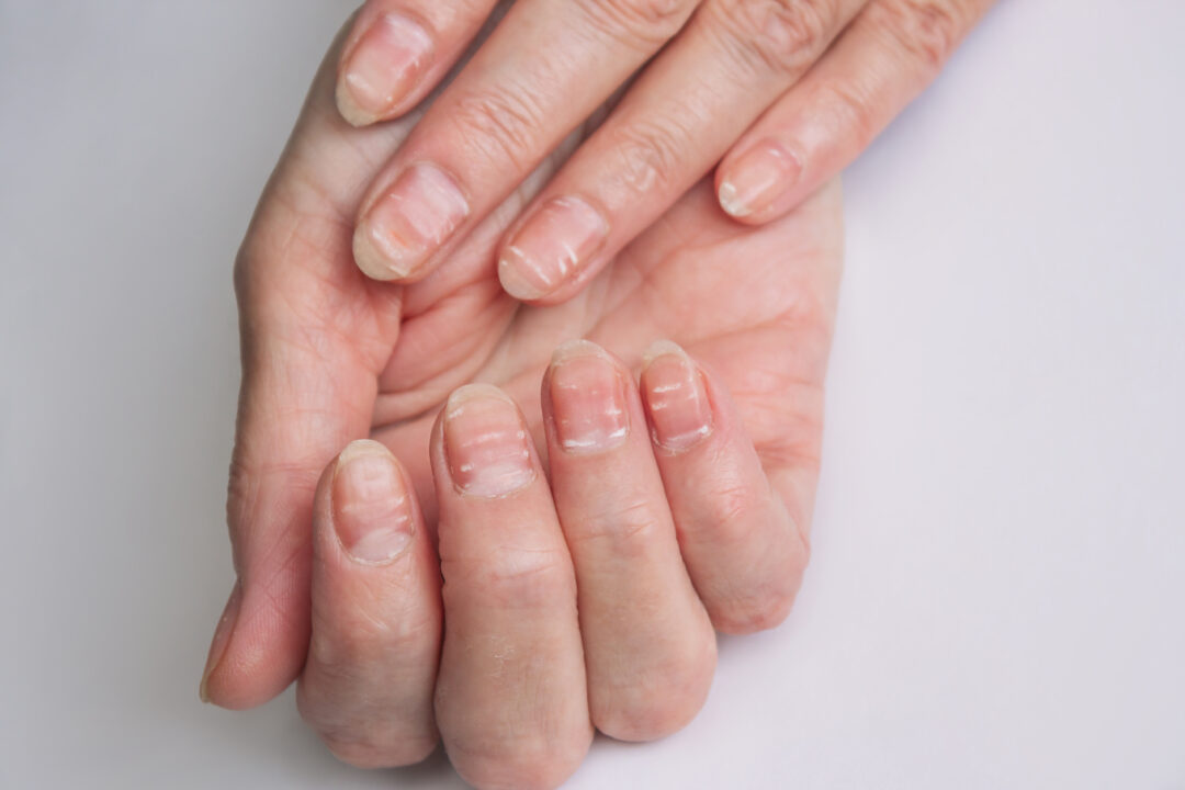 How to Spot and Fix the Most Common Signs of Nail Damage